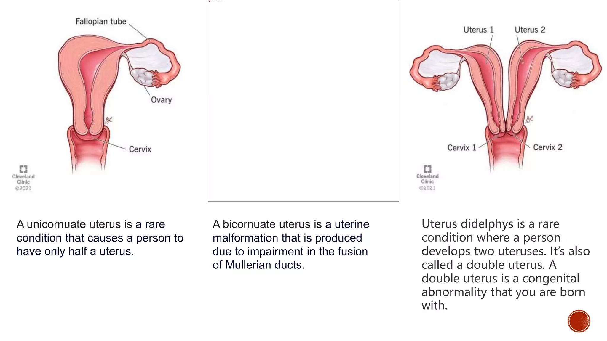 ABNORMALITIES IN DEVELOPMENT OF FEMALE GENITALIA | PPTX