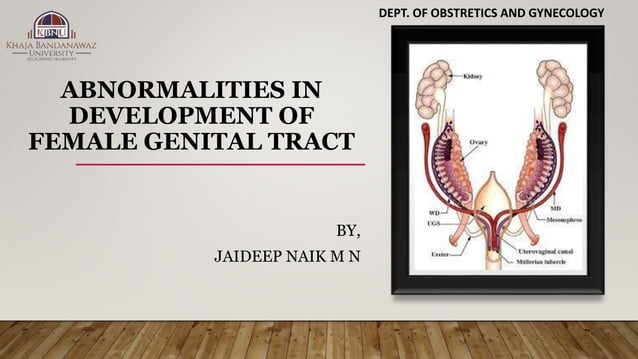 ABNORMALITIES IN DEVELOPMENT OF FEMALE GENITALIA | PPTX