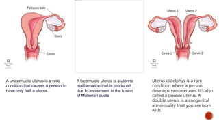 ABNORMALITIES IN DEVELOPMENT OF FEMALE GENITALIA | PPTX