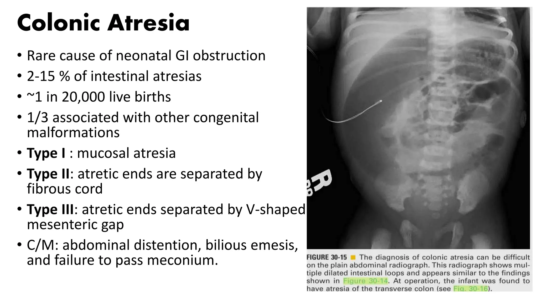 Embryology of GIT malformations by Dr. Yeneneh | PPTX