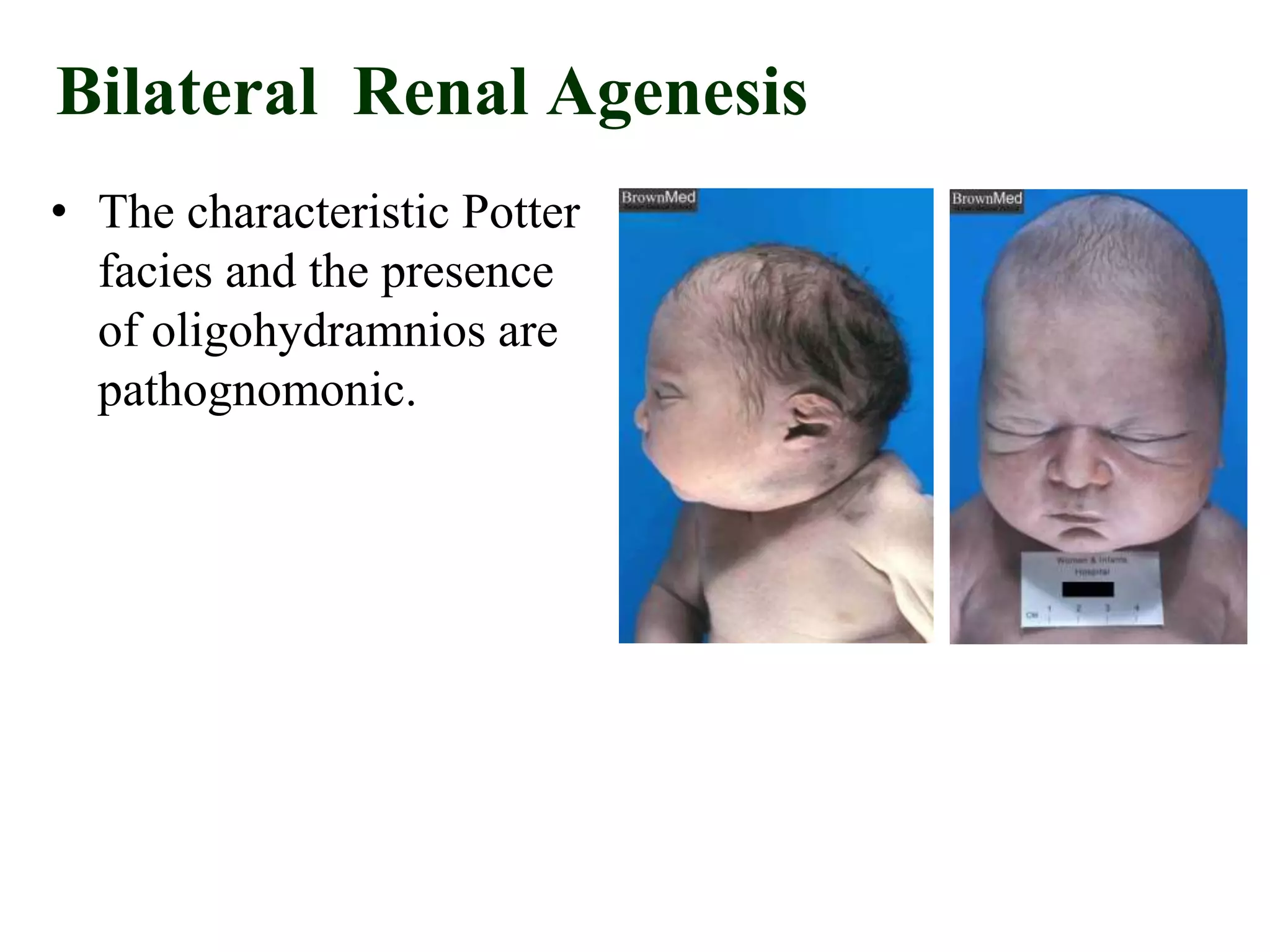 Embryology of kidney | PPTX