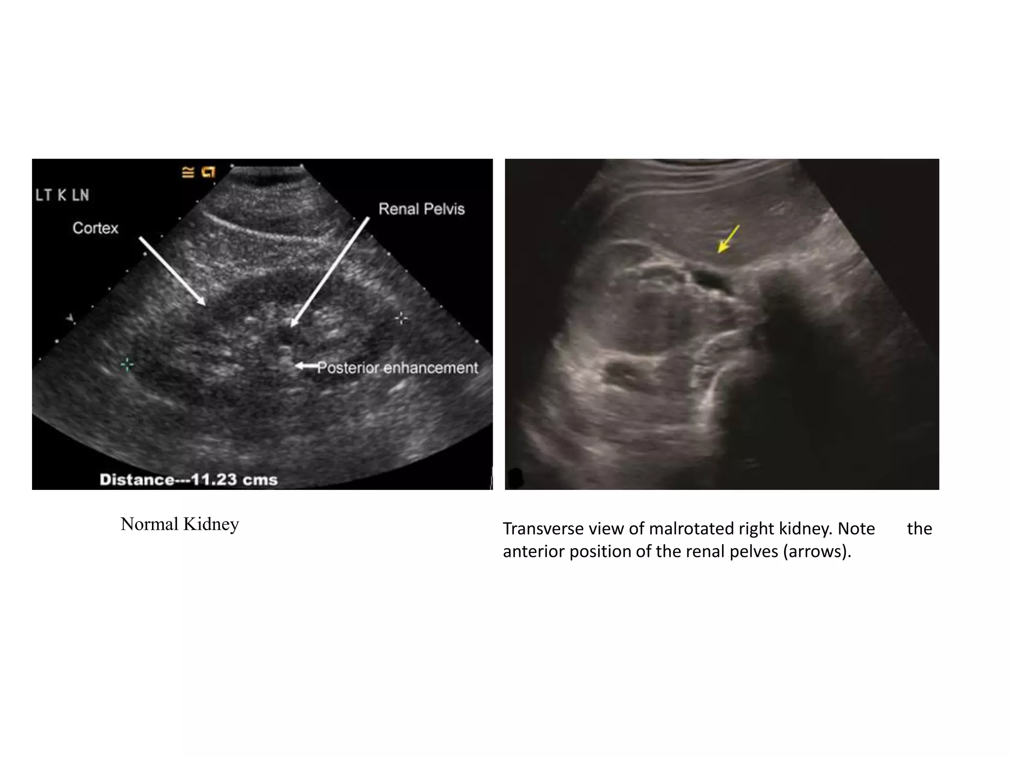 Embryology of kidney | PPTX