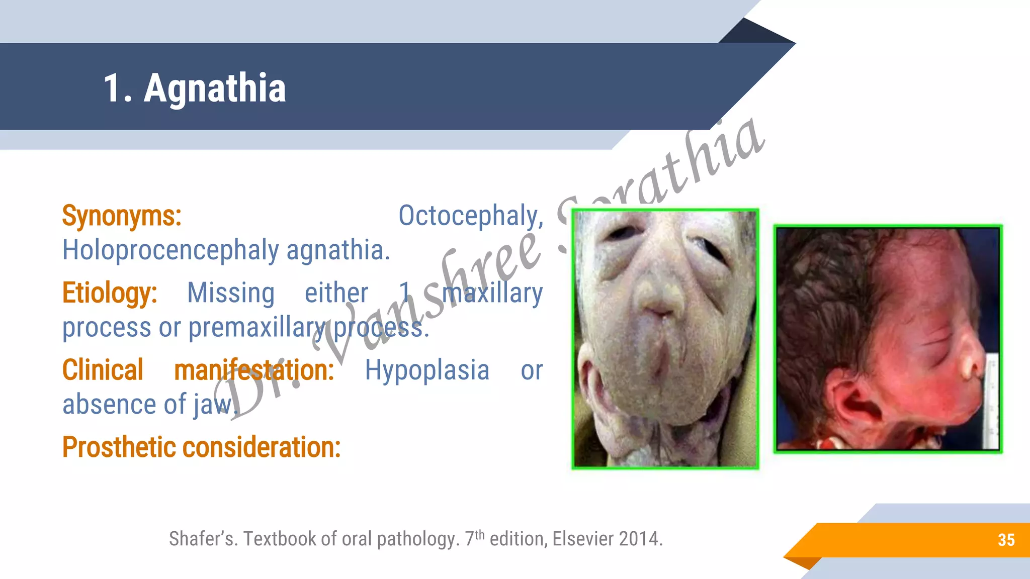 Embryology of Maxilla, Palate, Maxillary sinus & Lips and their Defects ...