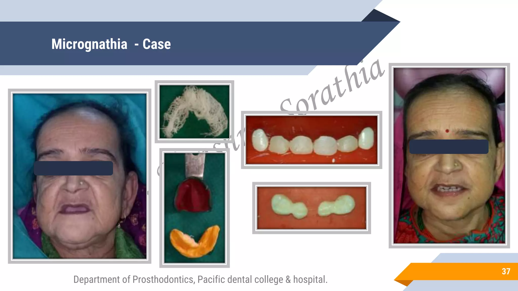 Embryology of Maxilla, Palate, Maxillary sinus & Lips and their Defects ...