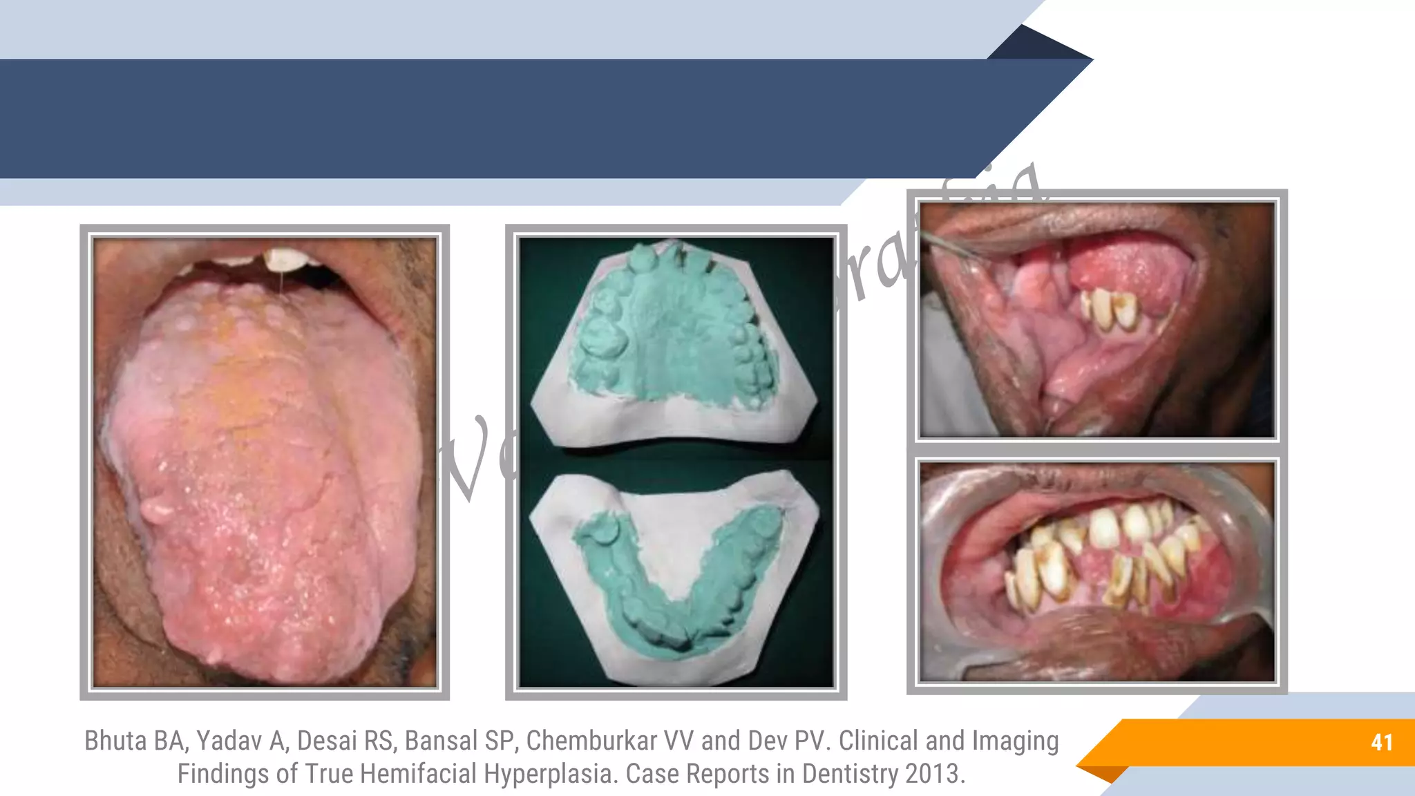 Embryology of Maxilla, Palate, Maxillary sinus & Lips and their Defects ...