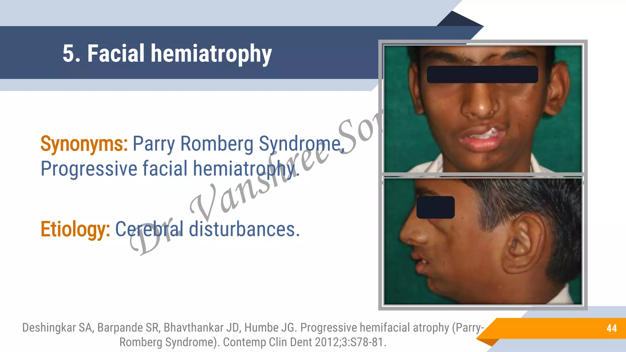 Embryology of Maxilla, Palate, Maxillary sinus & Lips and their Defects ...