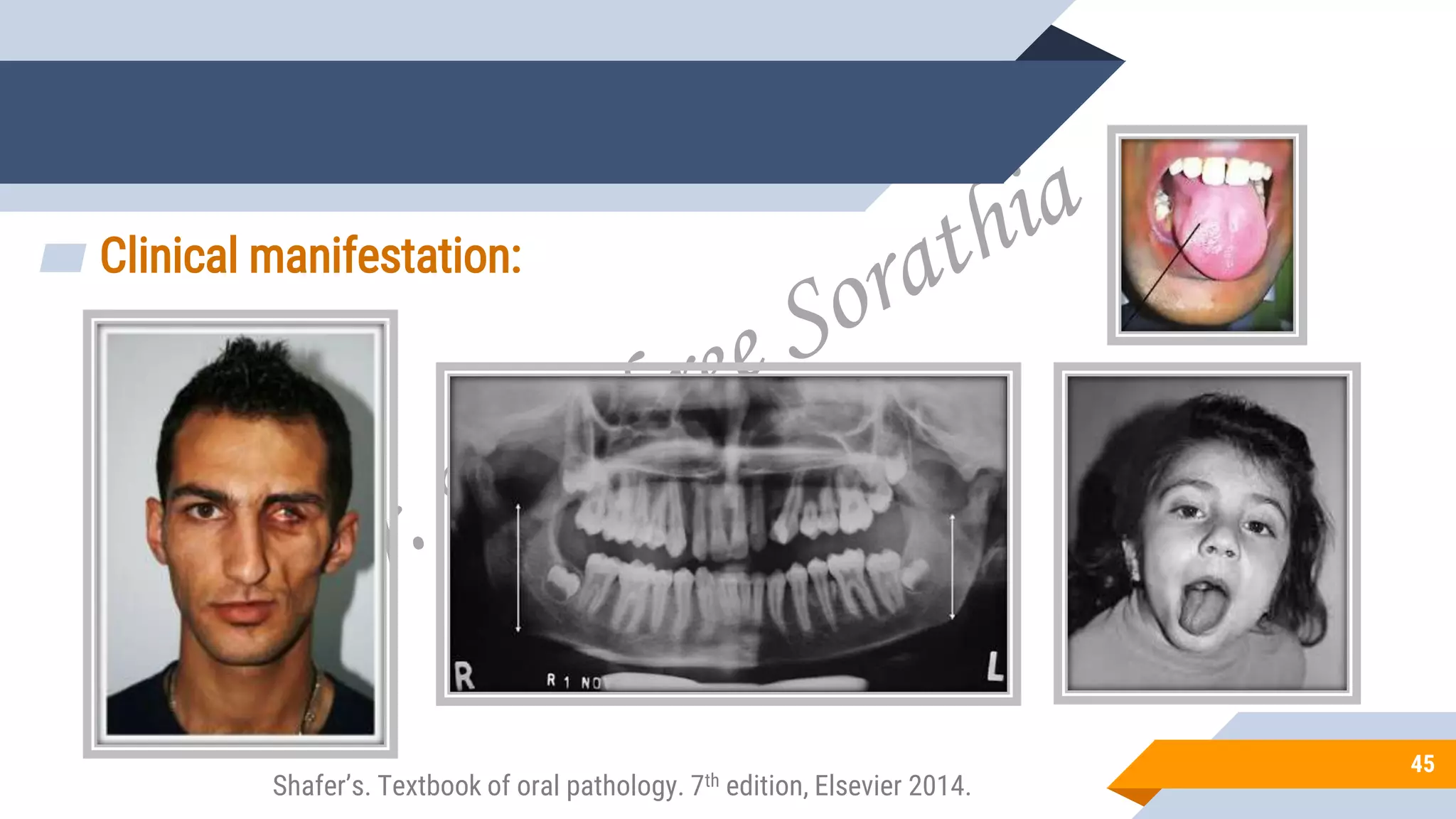 Embryology of Maxilla, Palate, Maxillary sinus & Lips and their Defects ...