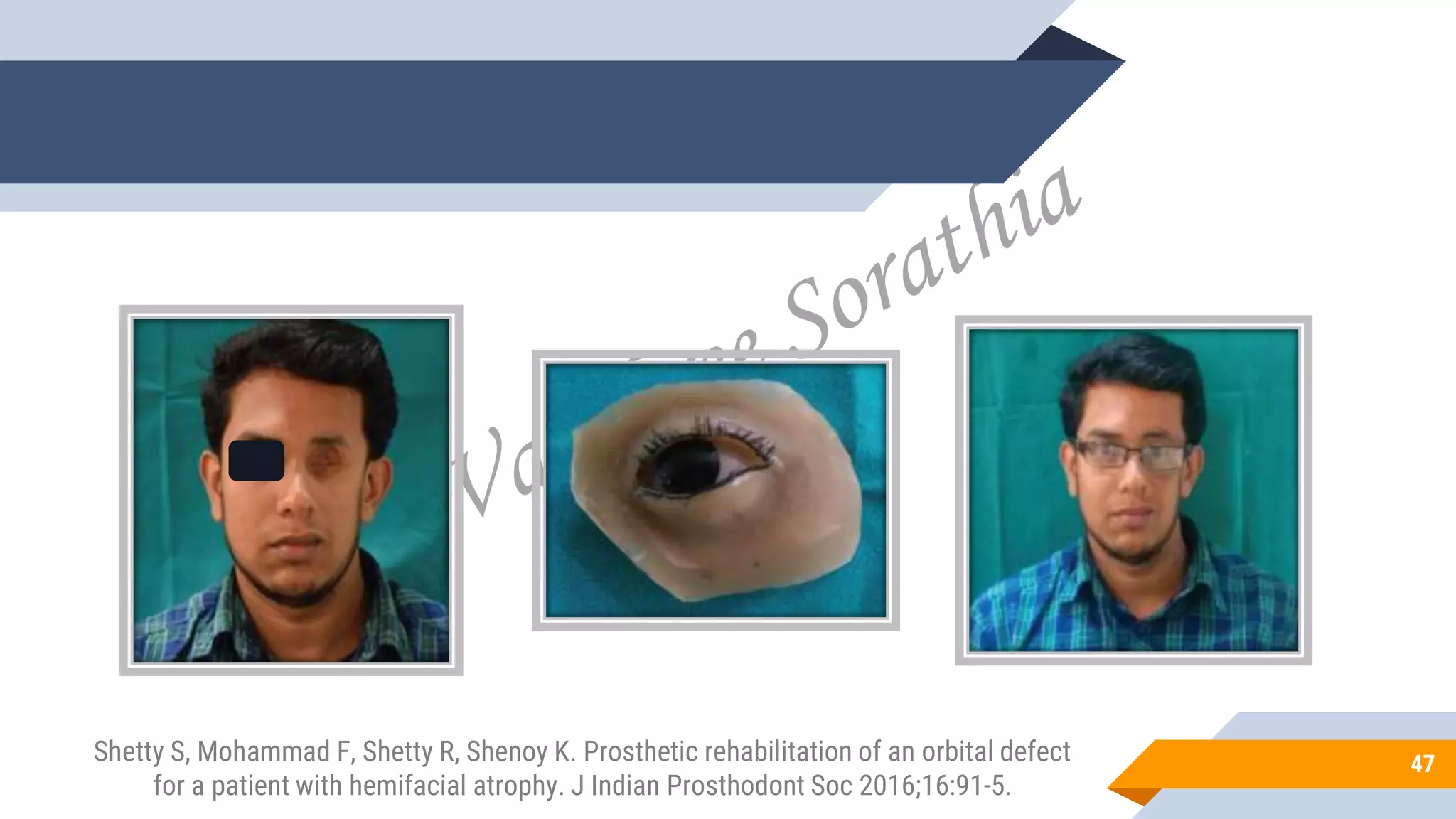 Embryology of Maxilla, Palate, Maxillary sinus & Lips and their Defects | PPTX