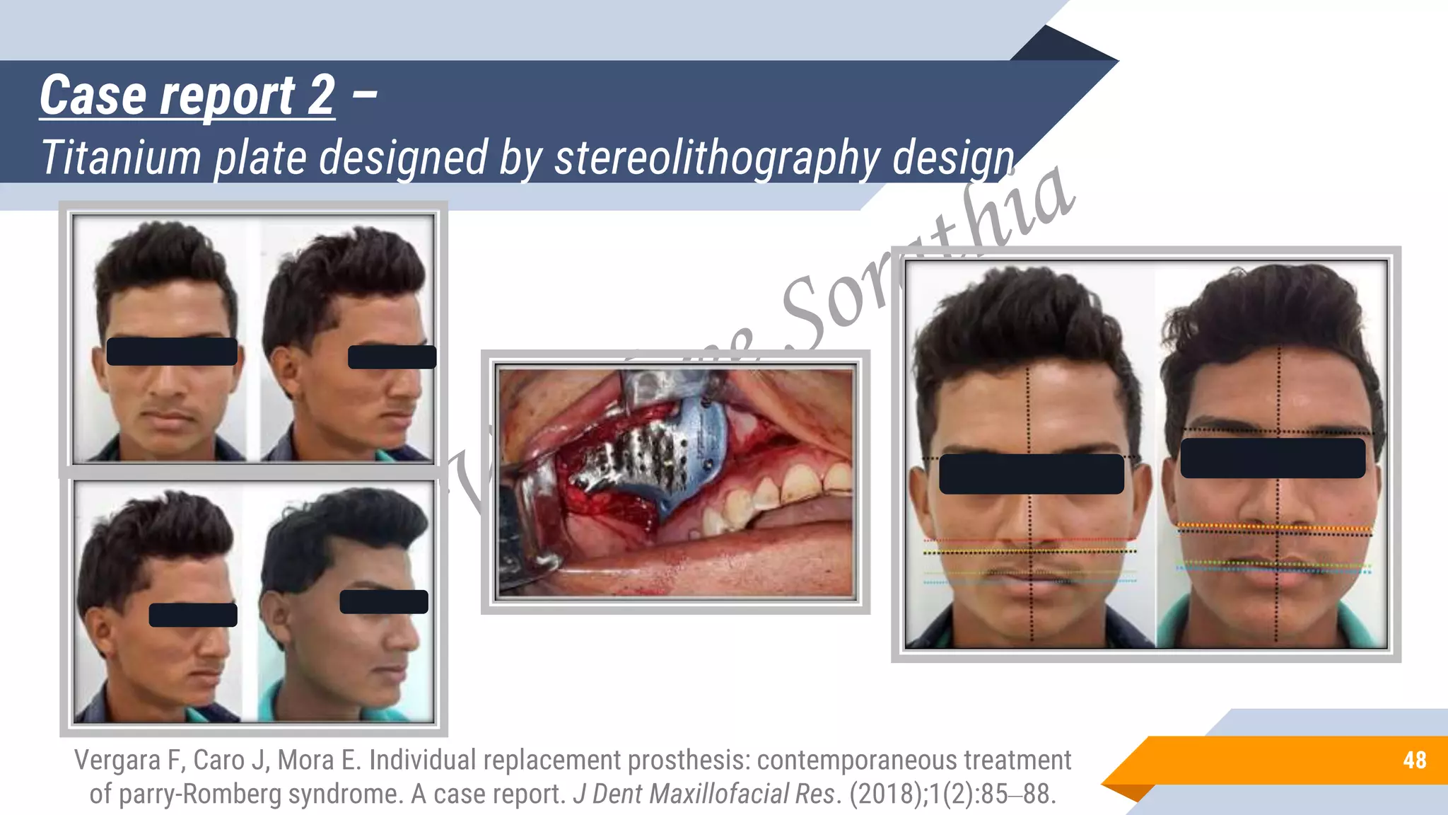 Embryology of Maxilla, Palate, Maxillary sinus & Lips and their Defects ...