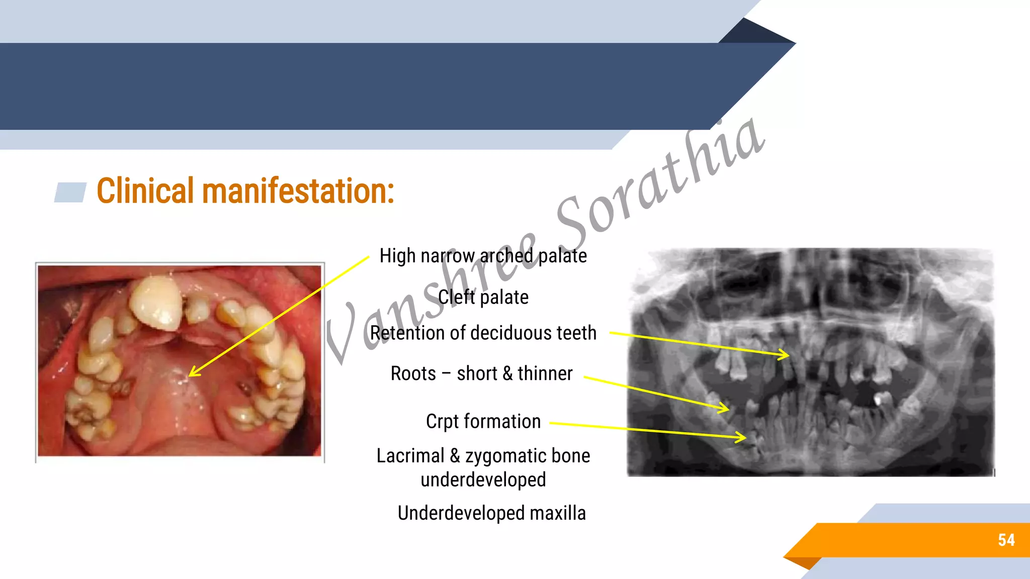 Embryology of Maxilla, Palate, Maxillary sinus & Lips and their Defects ...
