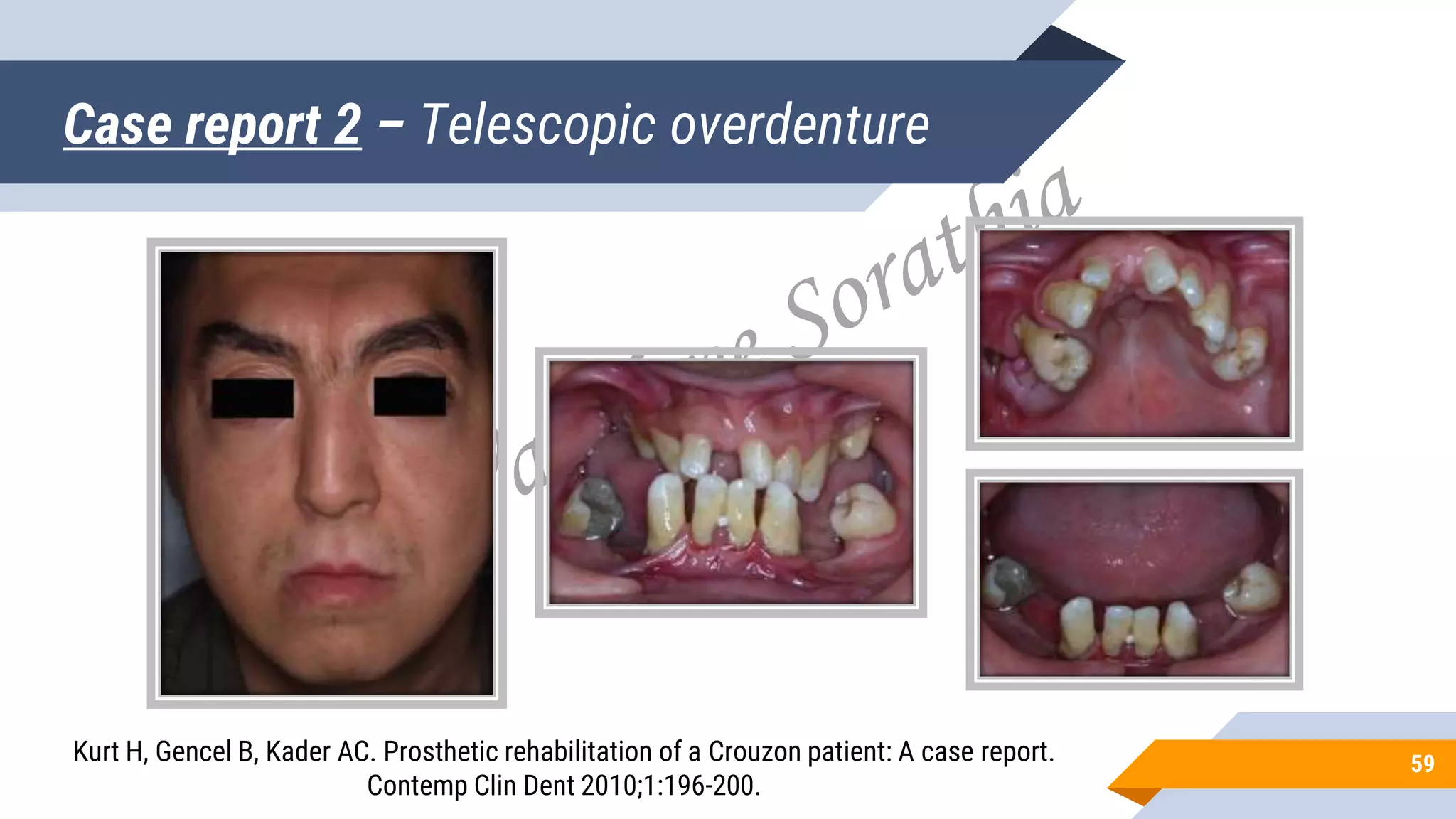 Embryology of Maxilla, Palate, Maxillary sinus & Lips and their Defects ...