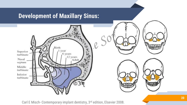 Embryology of Maxilla, Palate, Maxillary sinus & Lips and their Defects ...