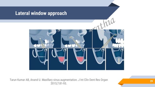 Embryology of Maxilla, Palate, Maxillary sinus & Lips and their Defects ...