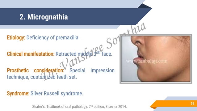 Embryology of Maxilla, Palate, Maxillary sinus & Lips and their Defects ...