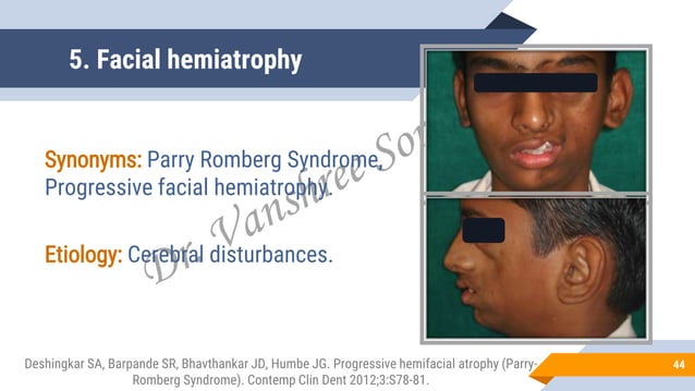 Embryology of Maxilla, Palate, Maxillary sinus & Lips and their Defects ...