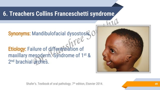 Embryology of Maxilla, Palate, Maxillary sinus & Lips and their Defects ...