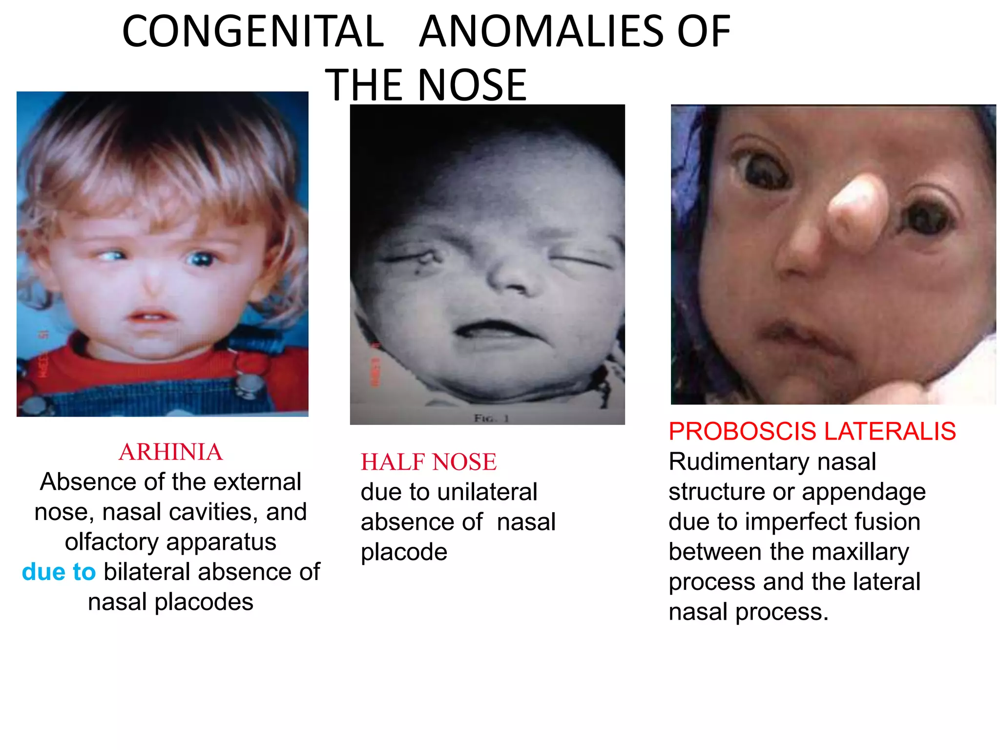 Embryology of nose 1440 copy | PPT