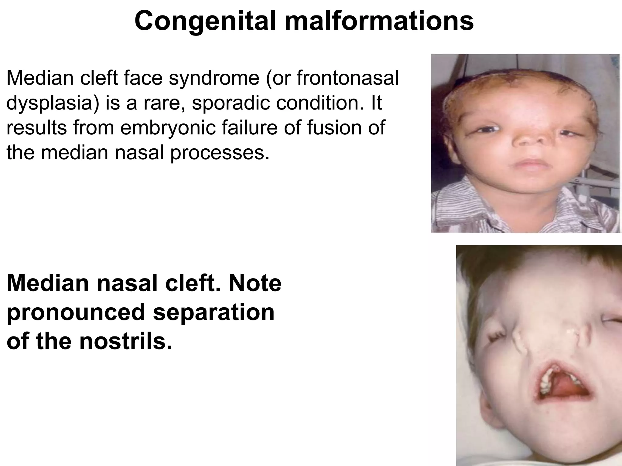 Embryology of nose 1440 copy | PPT