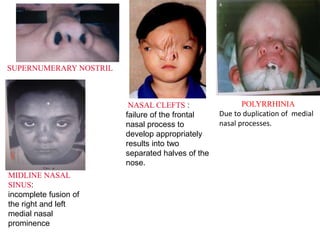 Embryology of nose 1440 copy | PPT