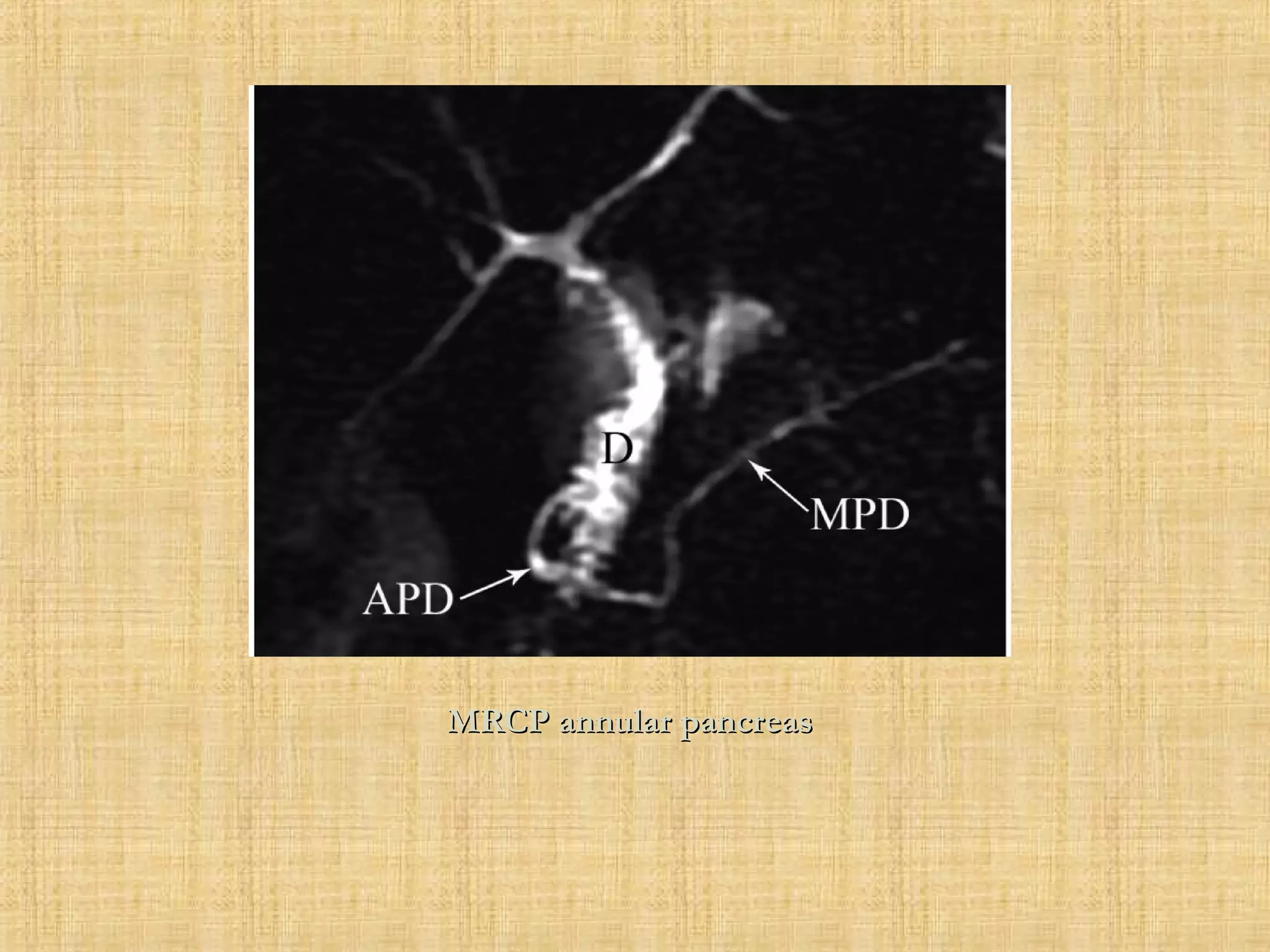 Embryology of pancreas and Imaging of pancreatitis | PPT