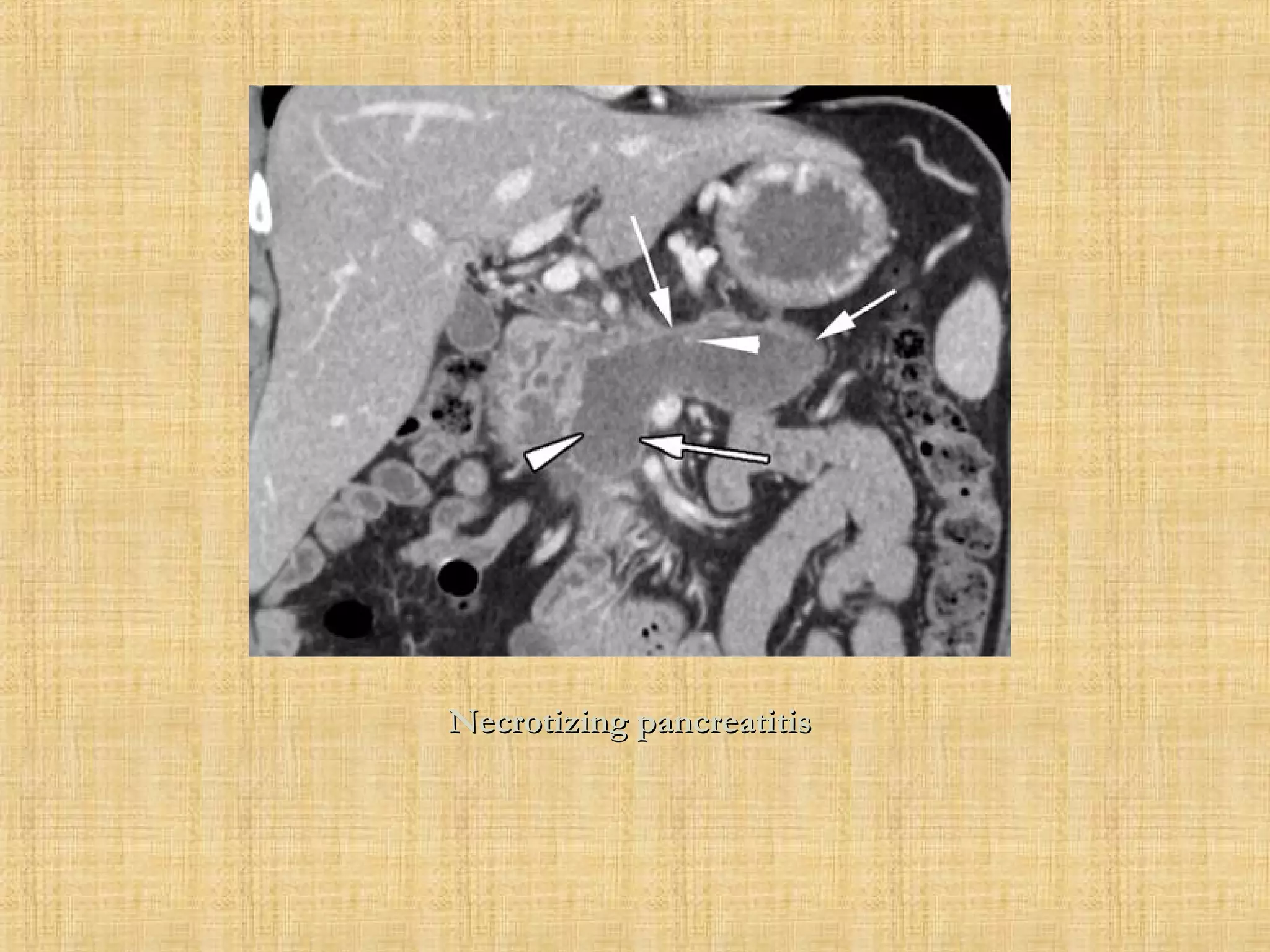 Embryology of pancreas and Imaging of pancreatitis | PPT