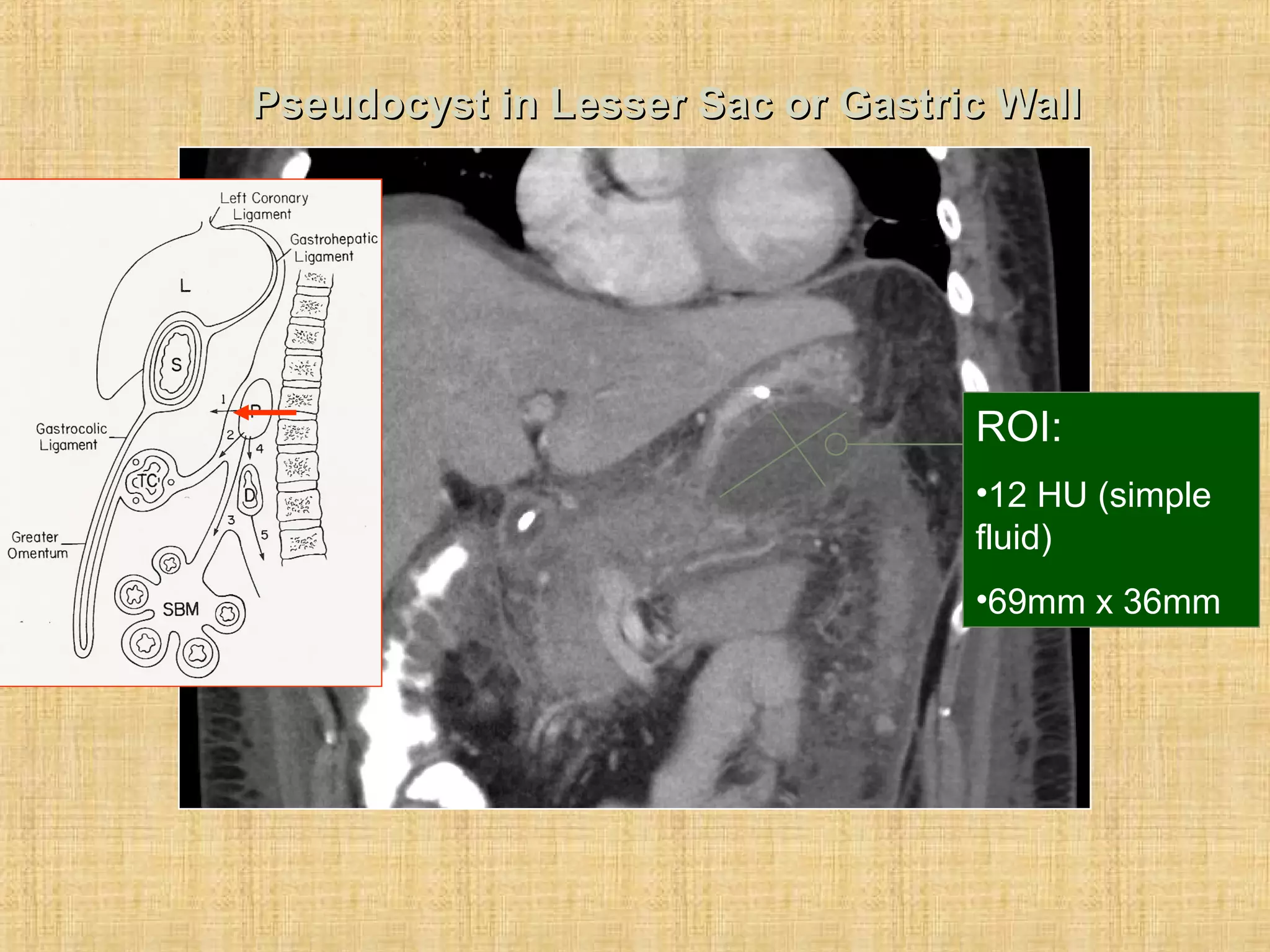 Embryology of pancreas and Imaging of pancreatitis | PPT