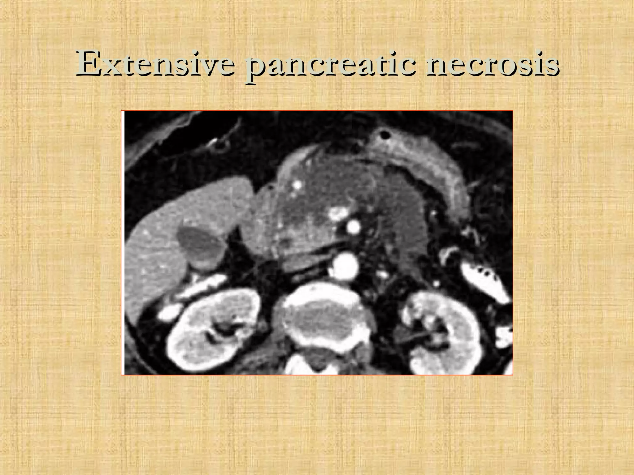 Embryology of pancreas and Imaging of pancreatitis | PPT