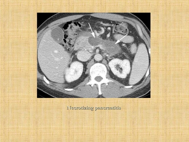 Embryology of pancreas and Imaging of pancreatitis | PPT
