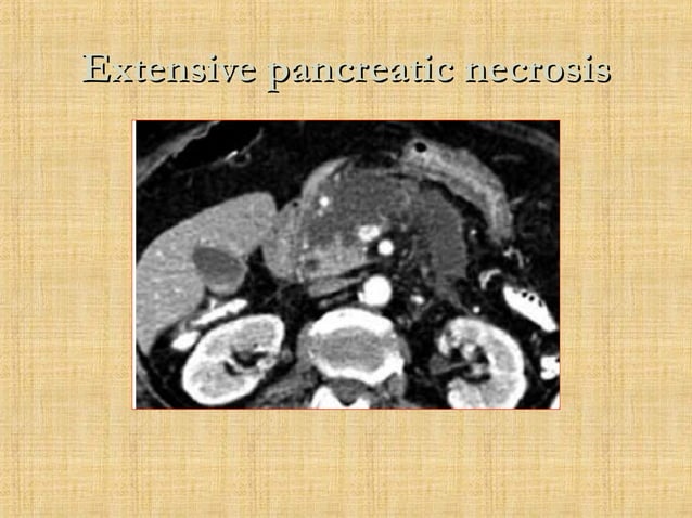 Embryology of pancreas and Imaging of pancreatitis | PPT