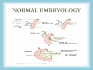 Annular Pancreas Embryology