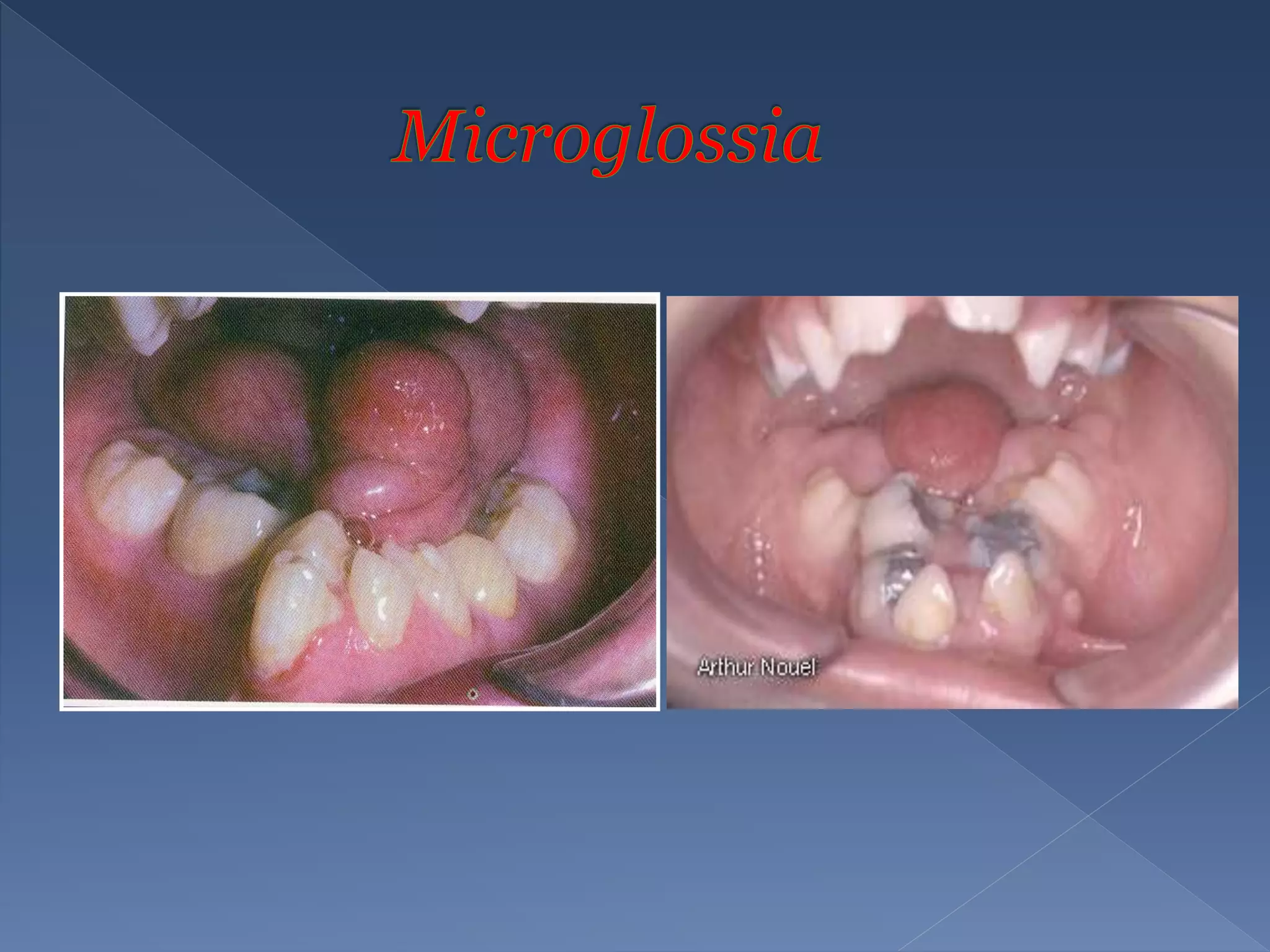 Embryology of tongue | PPTX