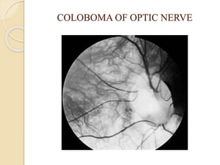 Embryology of Eye | PPTX