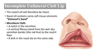 Embryology & Surgical Anatomy of Cleft Lip.pptx