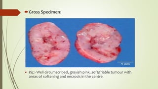 Embryonal brain tumours | PPT