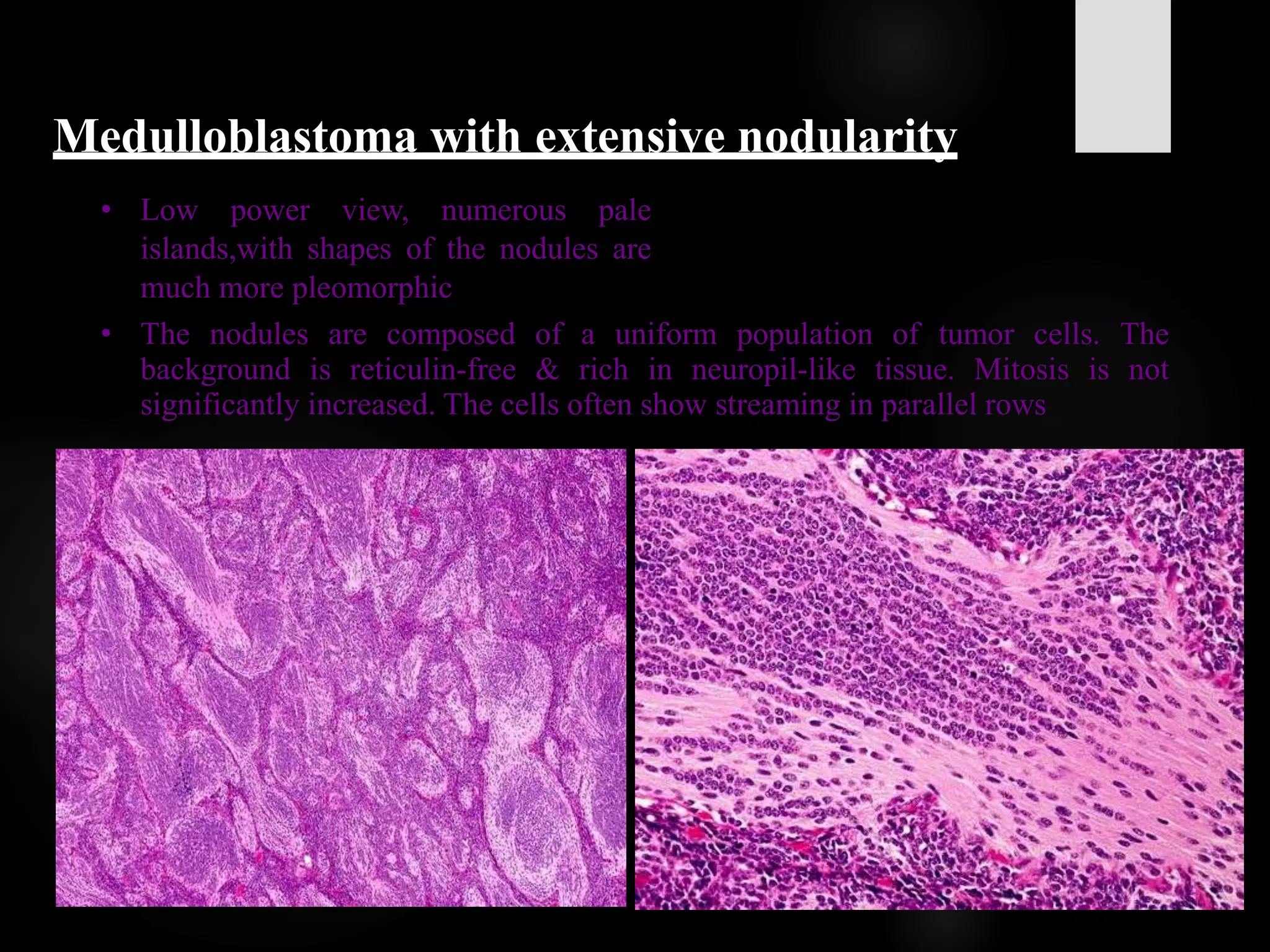 PEDIATRIC EMBRYONAL TUMOURS - UPDATE | PPT