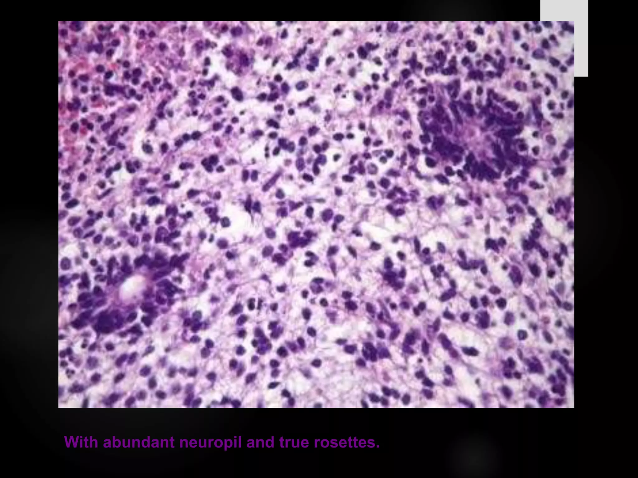 PEDIATRIC EMBRYONAL TUMOURS - UPDATE | PPT