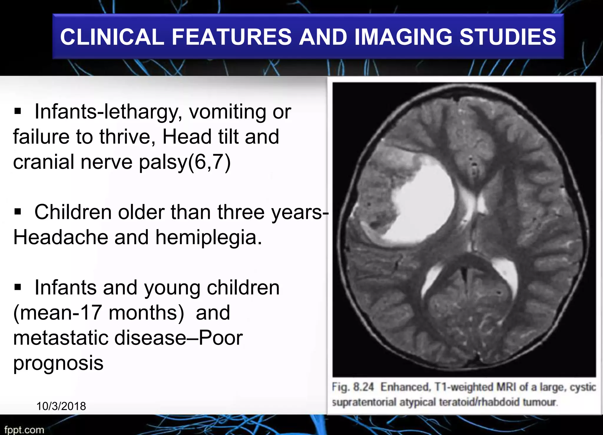 Embryonal tumors in children | PPTX