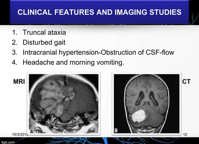 Embryonal tumors in children | PPTX | Brain and Nervous System ...