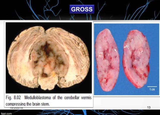 Embryonal tumors in children | PPTX | Brain and Nervous System ...