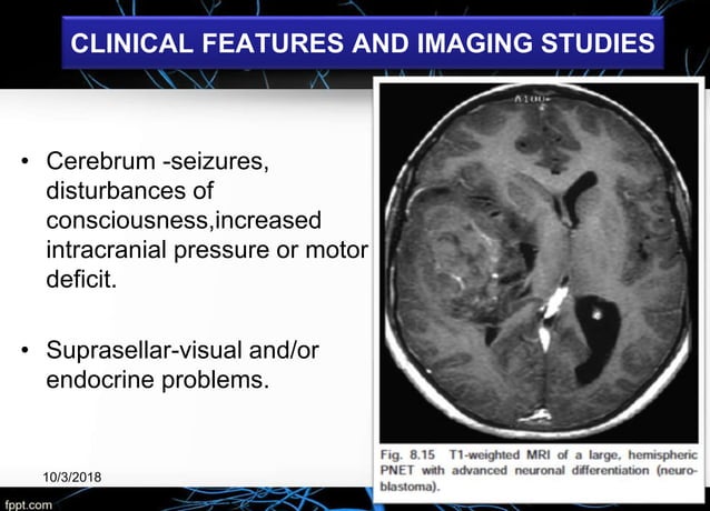 Embryonal tumors in children | PPTX | Brain and Nervous System ...