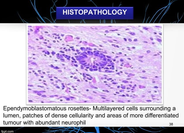 Embryonal tumors in children | PPTX | Brain and Nervous System ...