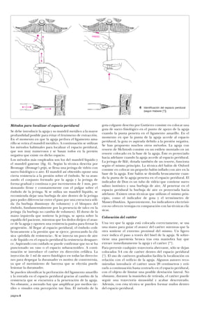 EMQ. Anestesia y Analgesia Peridurales | PDF