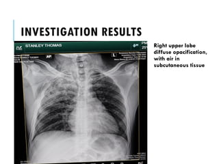 Lung contusion in emergency department #2.ppt