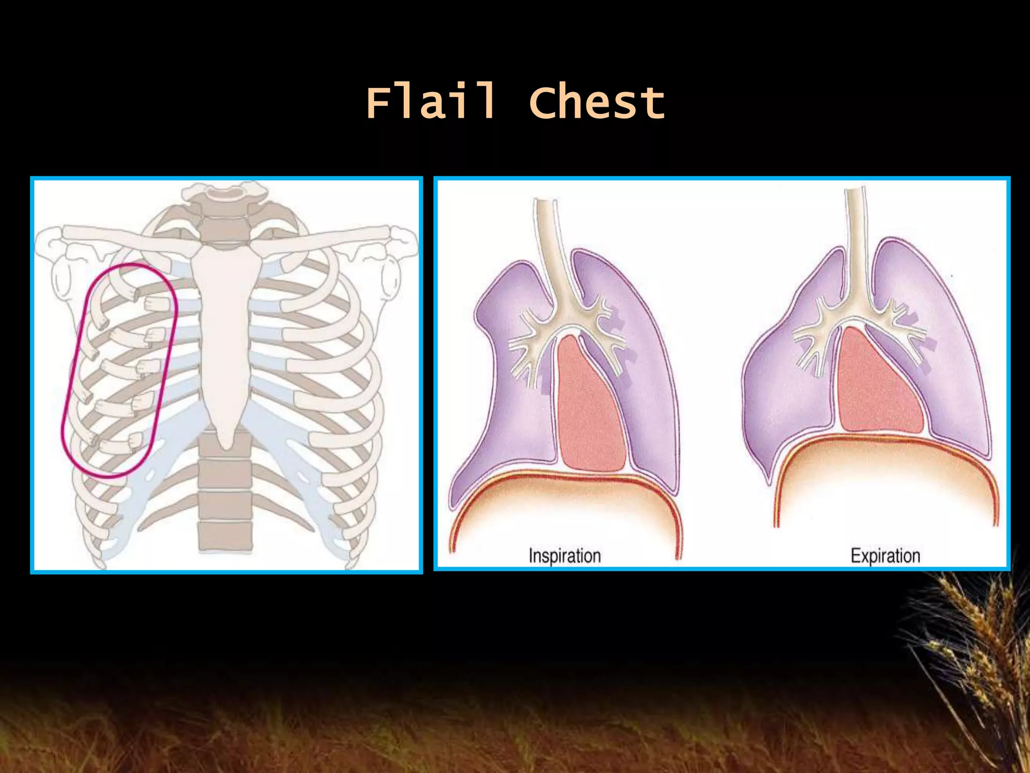 EMD1-K19-TRAUMA TORAKS.ppt