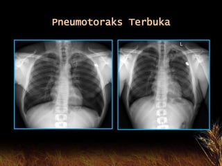 EMD1-K19-TRAUMA TORAKS.ppt