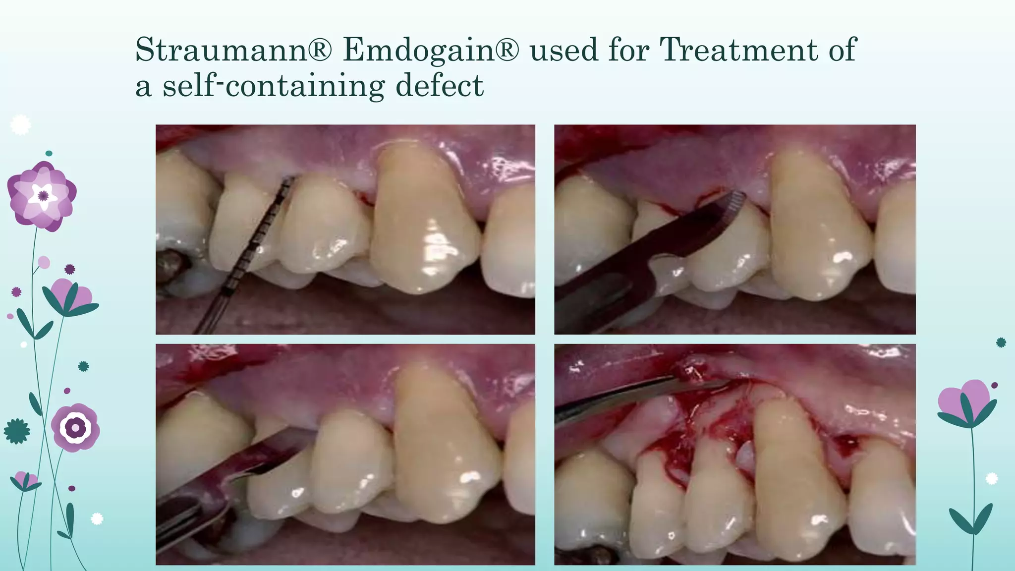 Emdogain by dr. maryam salman | PPTX
