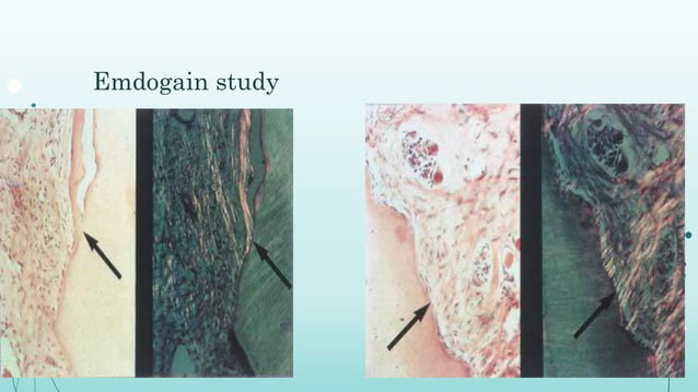 Emdogain by dr. maryam salman | PPTX | Oral care | Personal Care