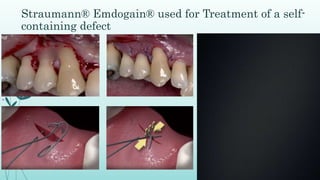 Emdogain by dr. maryam salman | PPTX