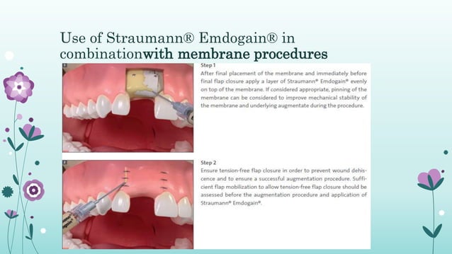 Emdogain by dr. maryam salman | PPTX | Oral care | Personal Care