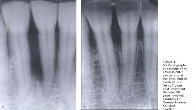 Emdogain by dr. maryam salman